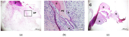 Osteomyelitis Possibly Caused by Exfoliation of Primary Teeth in a ...