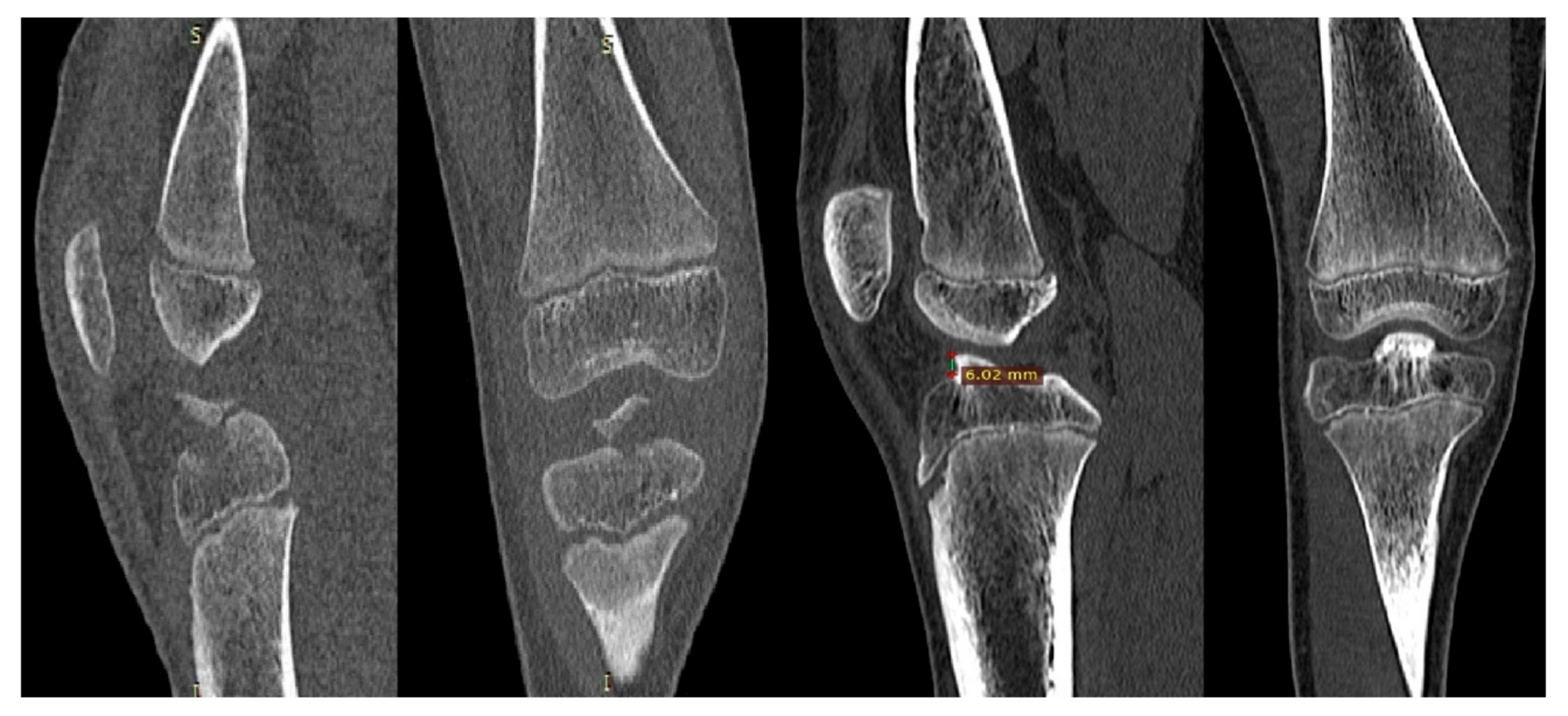 Results of Anterior Cruciate Ligament Avulsion Fracture by Treatment Using Bioabsorbable Nails ...