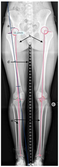The Importance of Monitoring and Factors That May Influence Leg Length ...