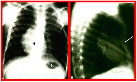 Diagnosis of Dextrocardia with a Pictorial Rendition of Terminology and ...