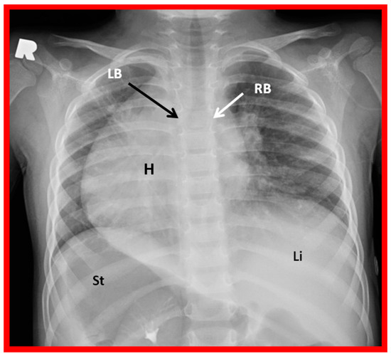 Diagnosis of Dextrocardia with a Pictorial Rendition of Terminology and ...