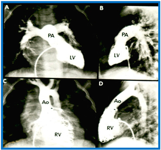 Diagnosis of Dextrocardia with a Pictorial Rendition of Terminology and ...