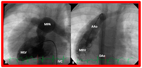Diagnosis of Dextrocardia with a Pictorial Rendition of Terminology and ...
