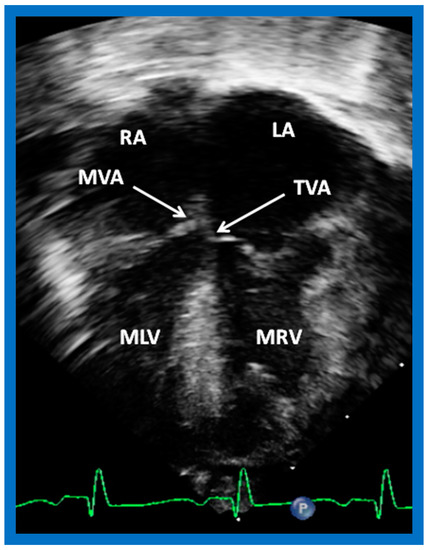 Diagnosis of Dextrocardia with a Pictorial Rendition of Terminology and ...