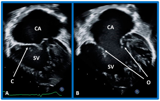 Diagnosis of Dextrocardia with a Pictorial Rendition of Terminology and ...