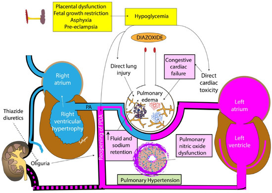 Diazoxide for Neonatal Hyperinsulinemic Hypoglycemia and Pulmonary ...