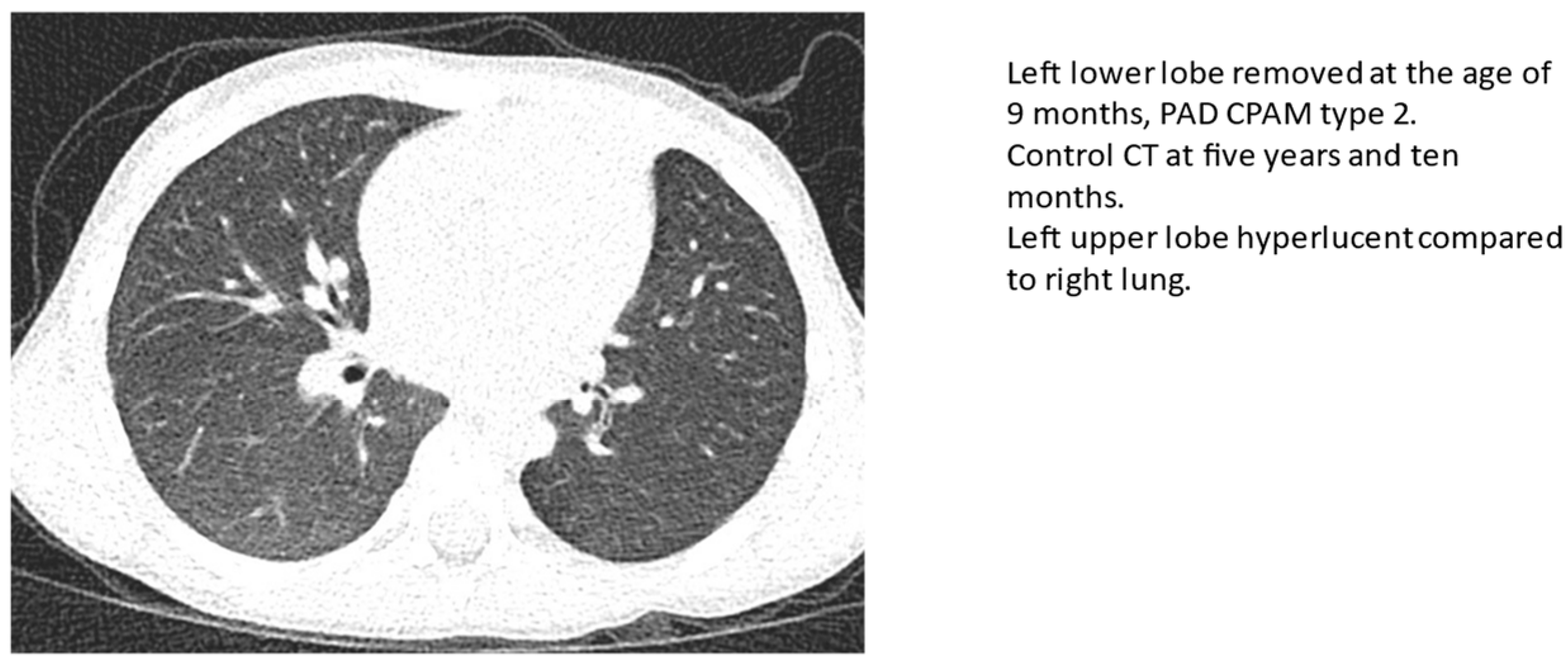 Long-Term Results of Pediatric Congenital Pulmonary Malformation: A ...