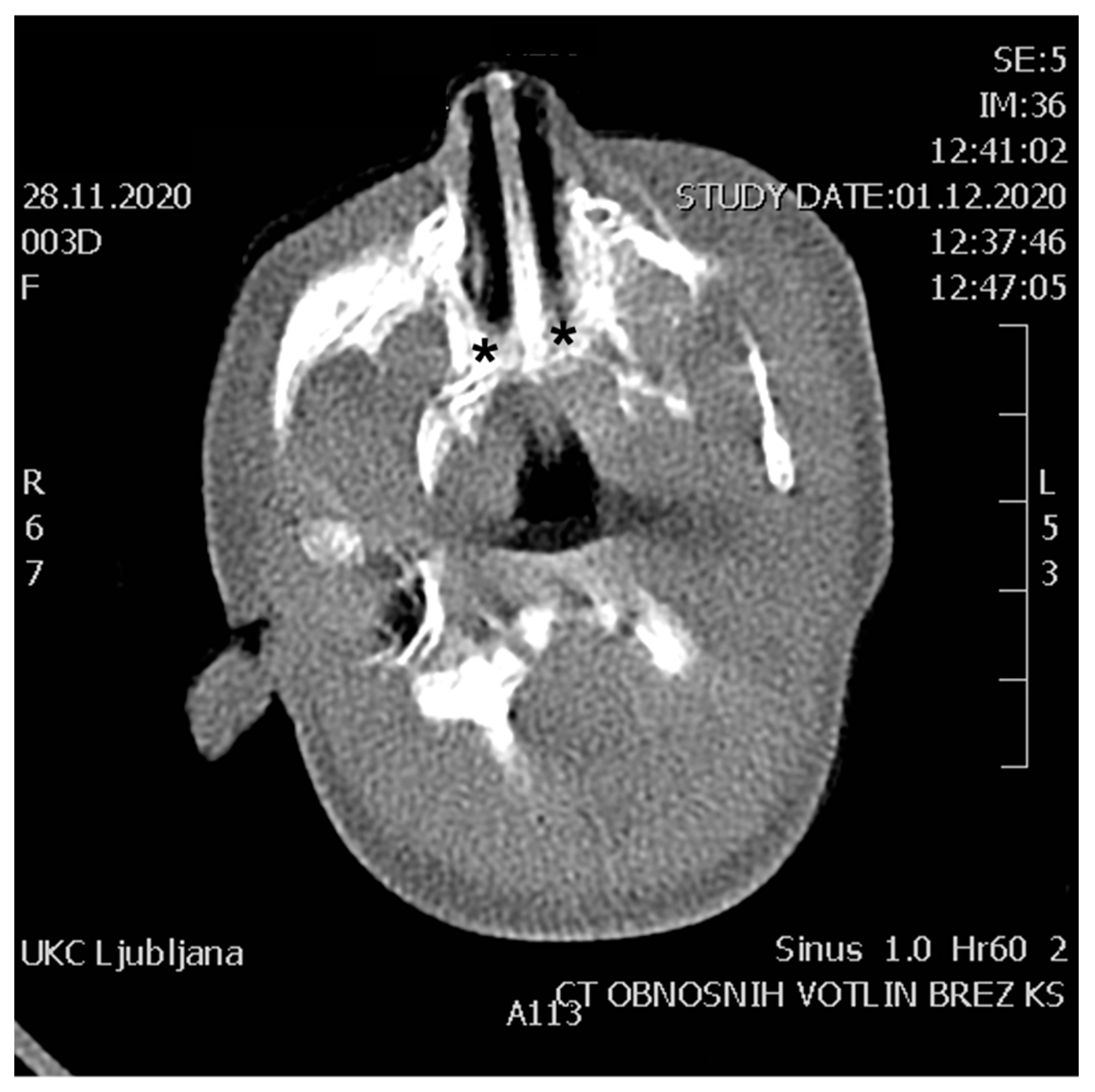 Management of Choanal Atresia: National Recommendations with a ...