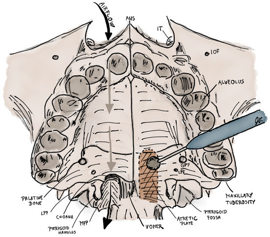 Management of Choanal Atresia: National Recommendations with a ...