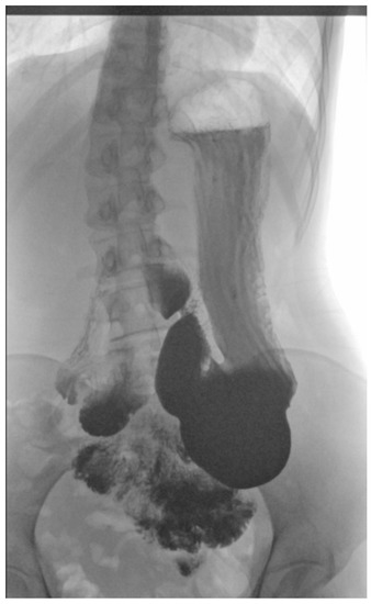 Postprandial Abdominal Pain Caused by Gastroptosis—A Case Report
