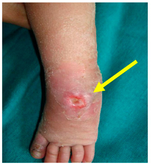 Common Errors in the Management of Idiopathic Clubfeet Using the ...