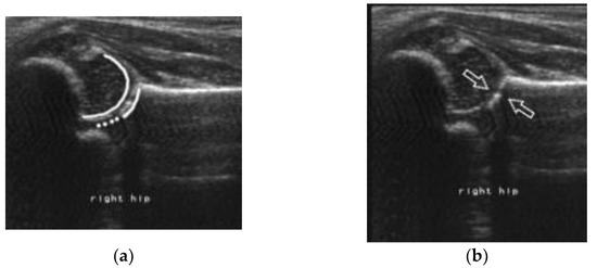 Concentric Circles: A New Ultrasonographic Sign for the Diagnosis of ...