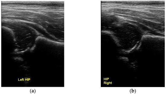 Concentric Circles: A New Ultrasonographic Sign for the Diagnosis of ...