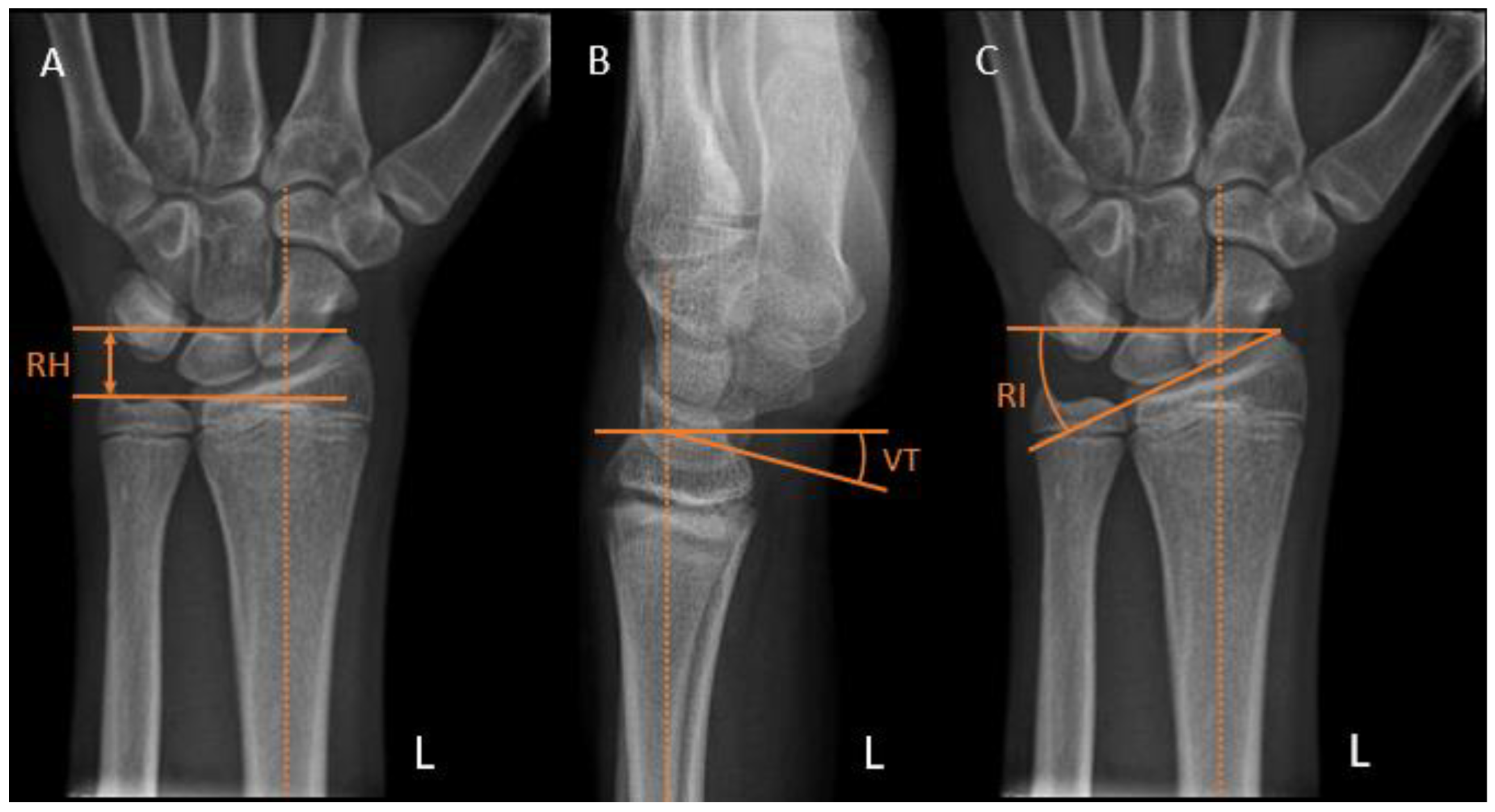 Distal Radius Radiographic Parameters Youtube