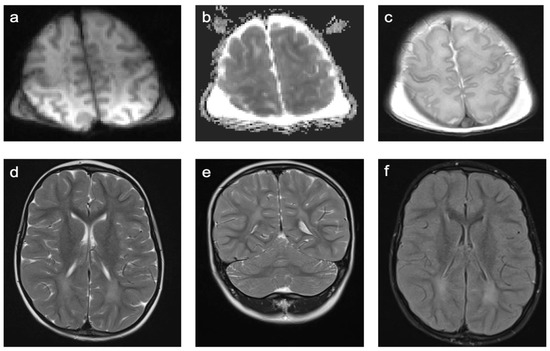 Characterization of MRI White Matter Signal Abnormalities in the ...