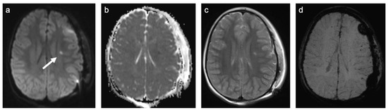 Characterization of MRI White Matter Signal Abnormalities in the ...
