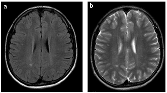 Characterization of MRI White Matter Signal Abnormalities in the Pediatric Population