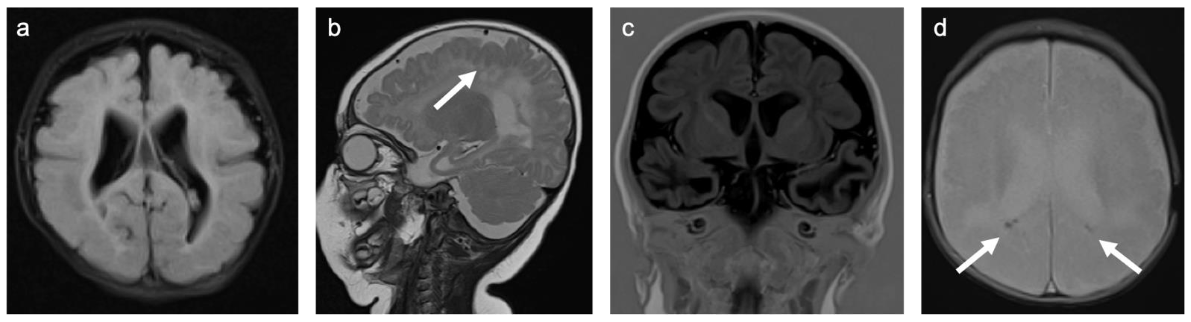 Characterization of MRI White Matter Signal Abnormalities in the Pediatric Population