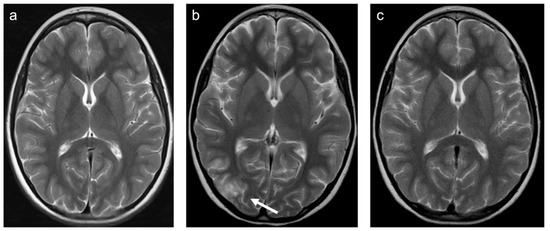 Characterization of MRI White Matter Signal Abnormalities in the ...
