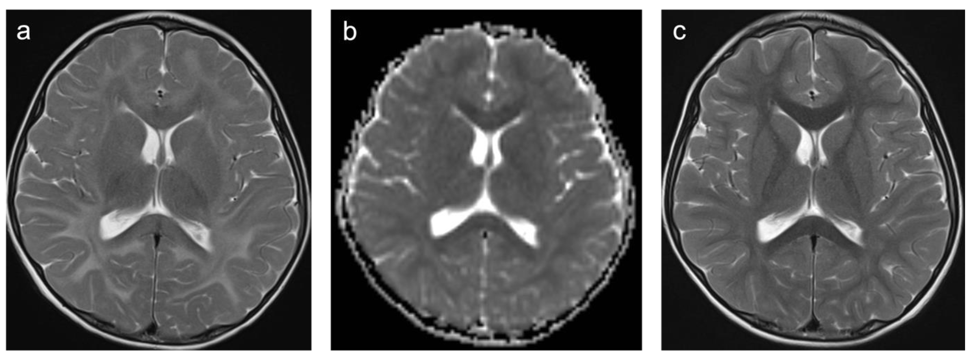 Characterization of MRI White Matter Signal Abnormalities in the ...