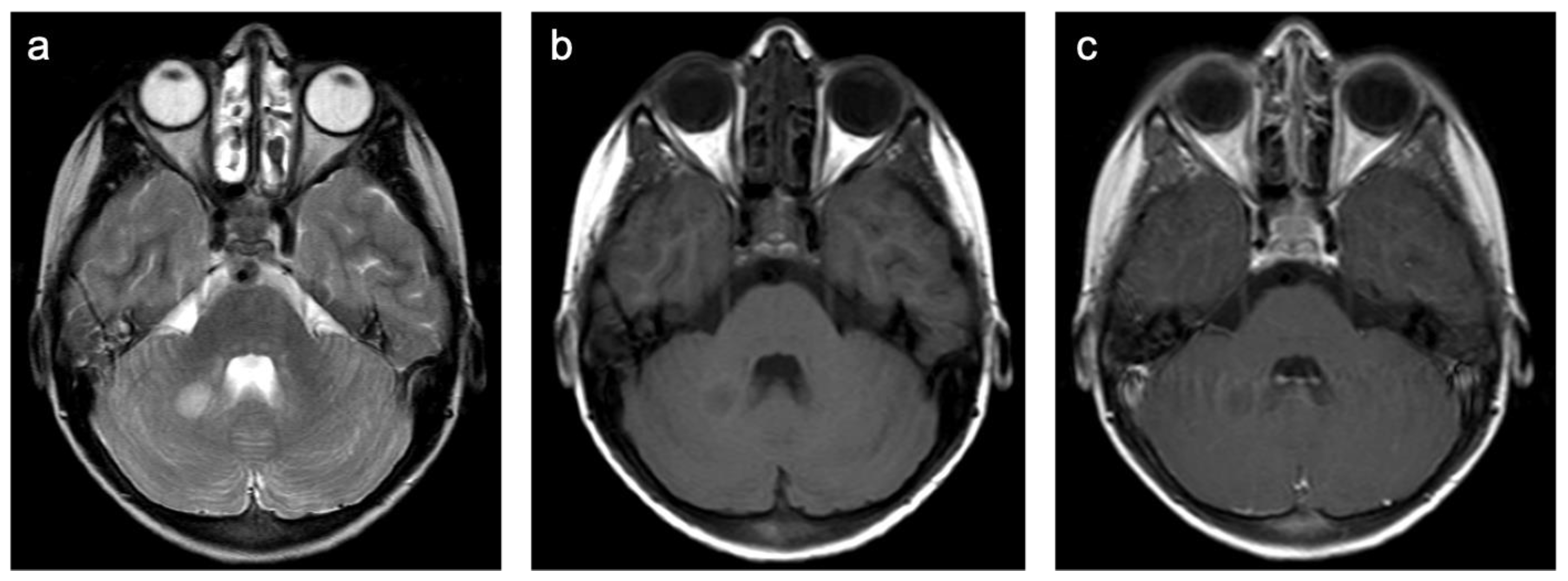 Characterization of MRI White Matter Signal Abnormalities in the Pediatric Population
