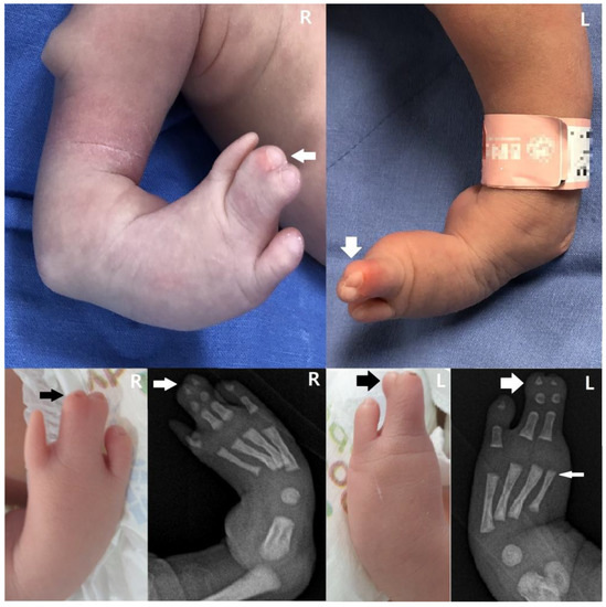 Distal Tibial Hemimelia in Fetal Methotrexate Syndrome: A Case Study ...