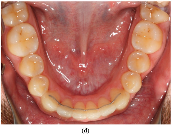 Children | Free Full-Text | Orthodontic Retainers—A Critical Review