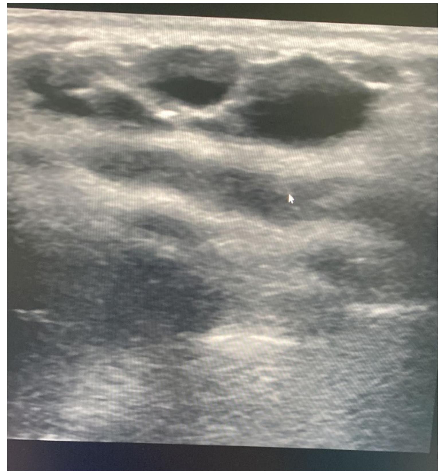 Sudden Appearance of a Palpable Chest Wall Mass Secondary to ...