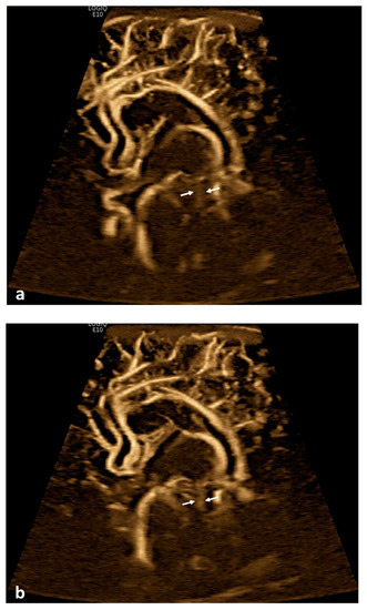 Evaluation of the Cerebrospinal Fluid Flow Dynamics with Microvascular ...