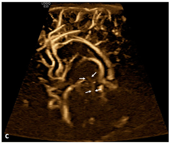 Evaluation of the Cerebrospinal Fluid Flow Dynamics with Microvascular ...