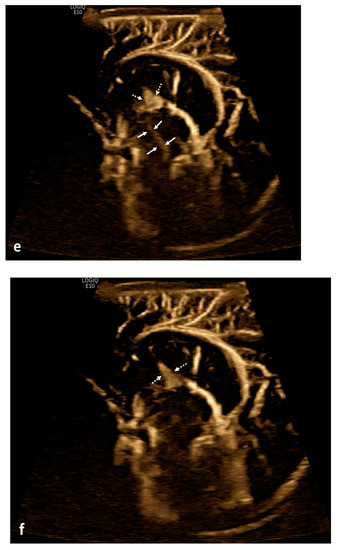 Evaluation of the Cerebrospinal Fluid Flow Dynamics with Microvascular ...