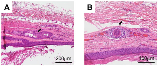 Sublingual Dermoid Cyst in Young Child