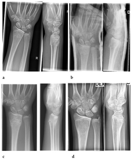 Clinical Follow Up Without Radiographs Is Sufficient After Most