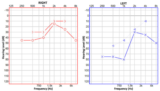 A Peculiar Case of Ossicular Chain Fixation and Enlarged Vestibular ...
