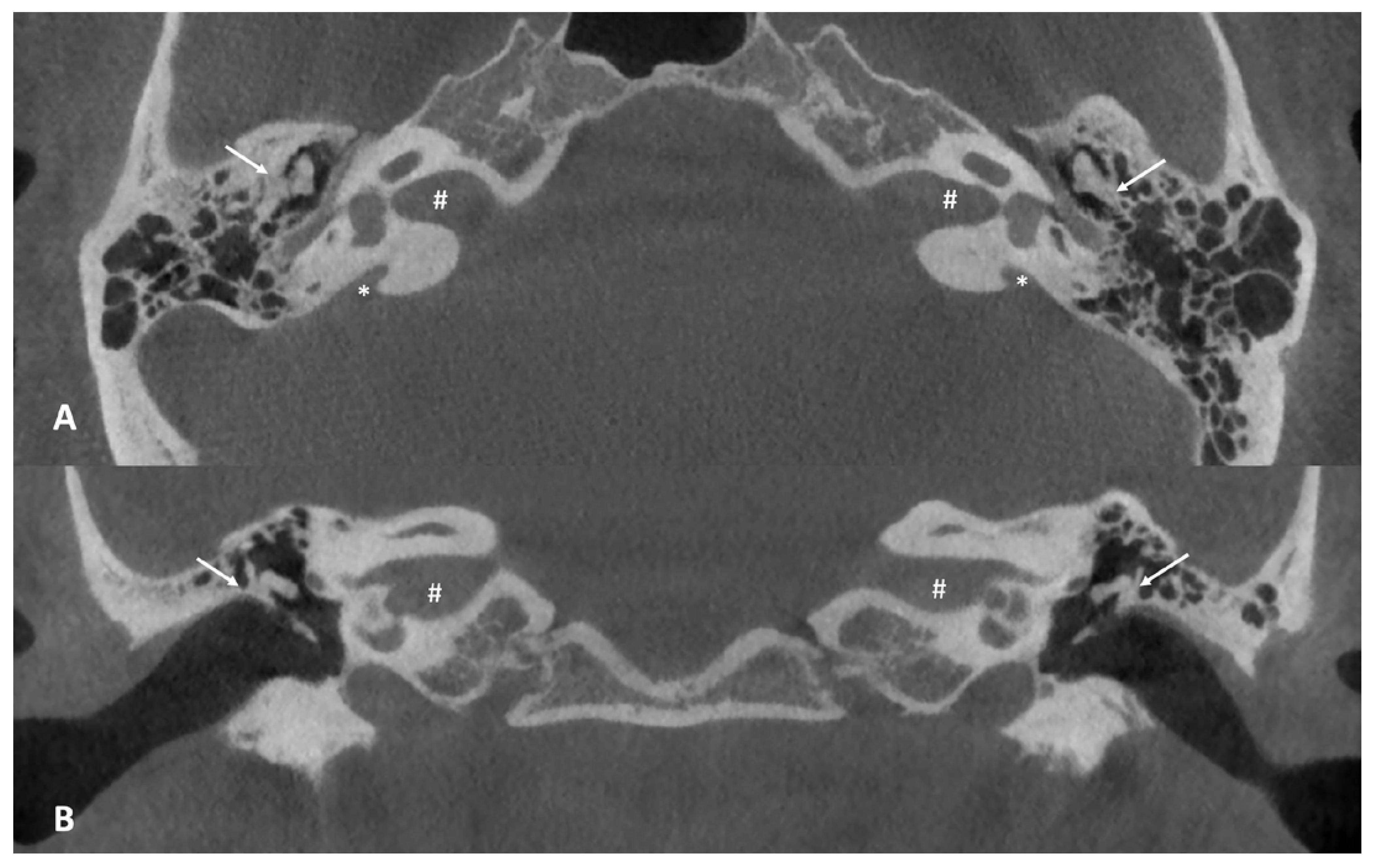A Peculiar Case of Ossicular Chain Fixation and Enlarged Vestibular ...