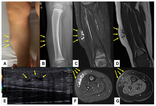 Subcutaneous Granuloma Annulare vs. Subcutaneous Vascular Malformations ...