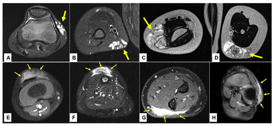 Subcutaneous Granuloma Annulare vs. Subcutaneous Vascular Malformations ...