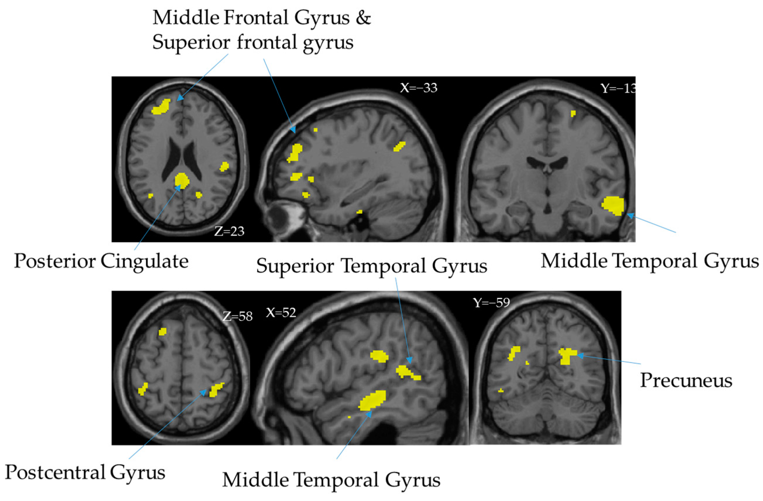 Superior Frontal Gyrus Mri