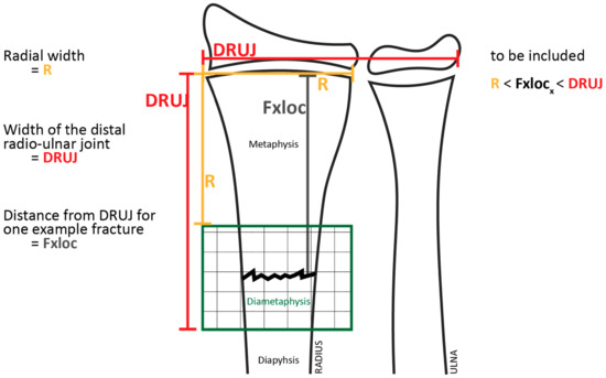 Children | Free Full-Text | Diametaphyseal Distal Forearm Fractures in ...