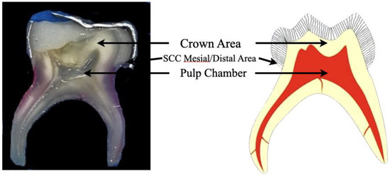 Bacterial Colonization and Proliferation in Primary Molars following ...