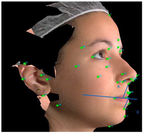 The Maxilla-Mandibular Discrepancies through Soft-Tissue References ...