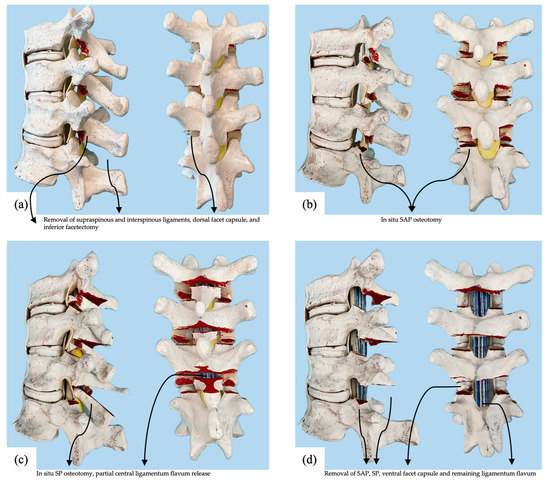 Introduction of a Novel Sequential Approach to the Ponte Osteotomy to ...