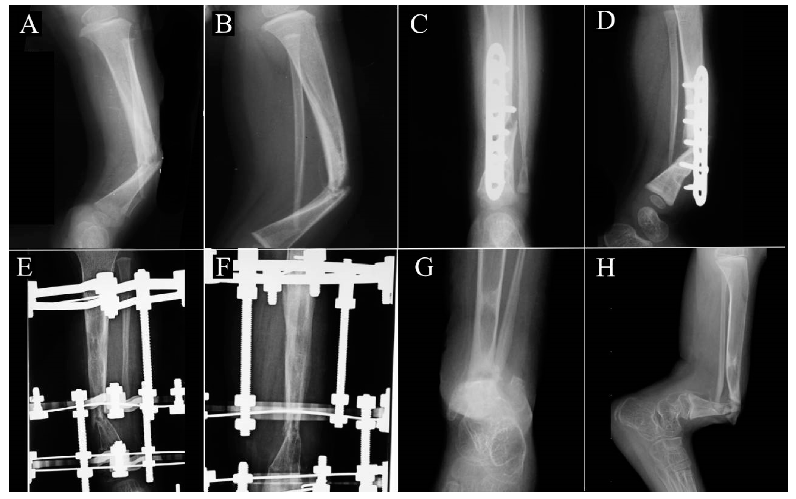 Treatment of Refractory Congenital Pseudoarthrosis of Tibia with ...