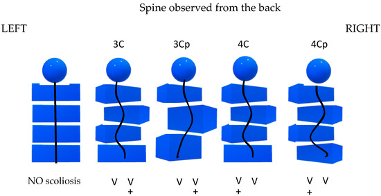 Algorithm for Schroth-Curve-Type Classification of Adolescent ...