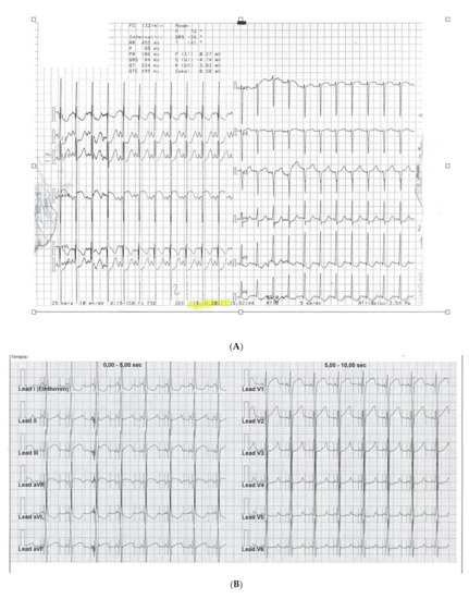 Acute Coronary Syndrome Treated with Percutaneous Coronary Intervention ...