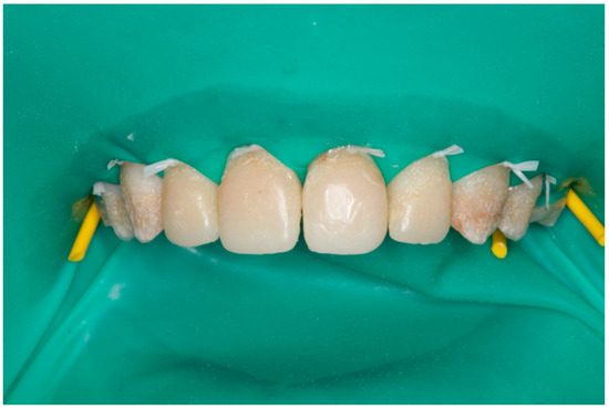 Esthetic Rehabilitation of Pediatric Patients Using Direct Bonding ...