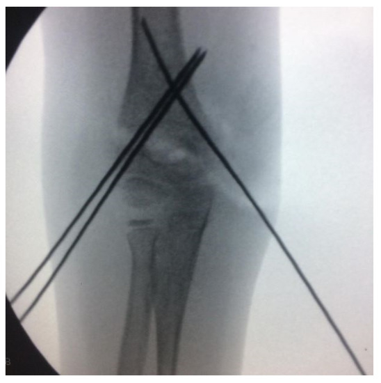 Extra Lateral Pin or Less Radiation? A Comparison of Two Different Pin ...
