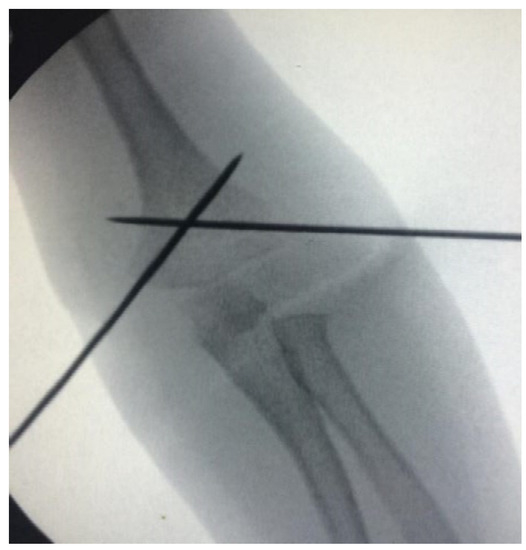 Extra Lateral Pin or Less Radiation? A Comparison of Two Different Pin ...