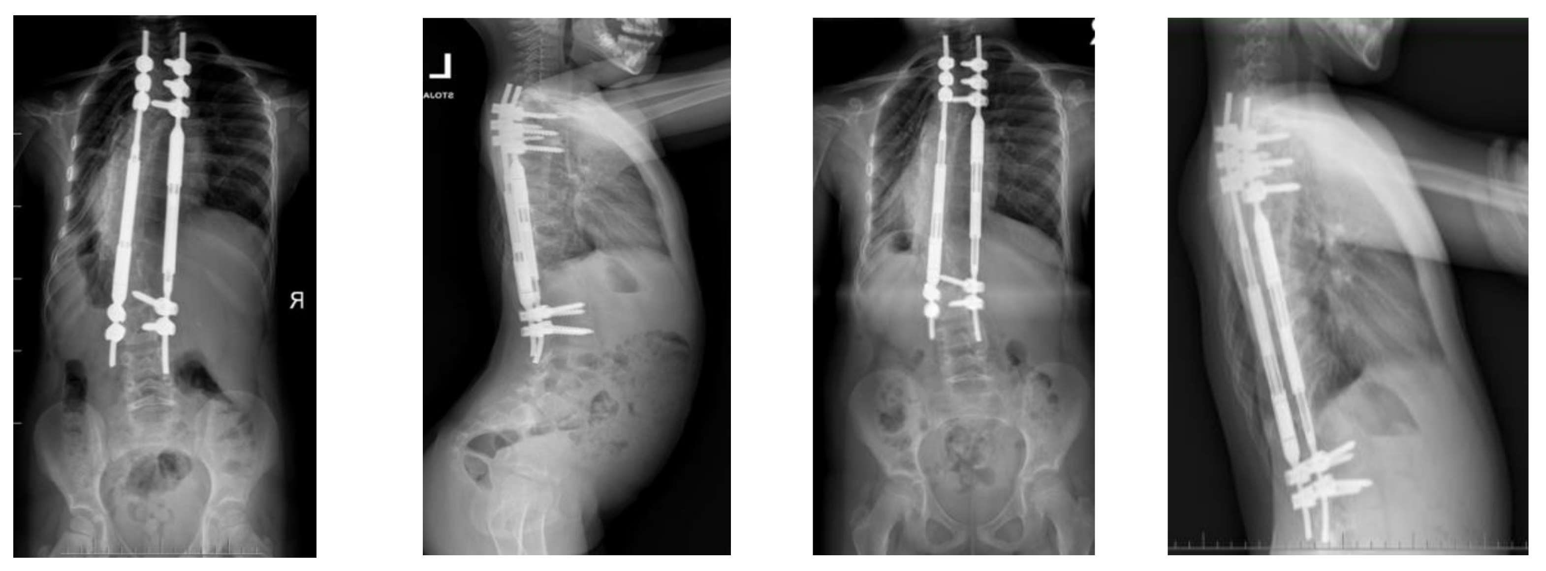 Less-Invasive Approach to Early-Onset Scoliosis—Surgical Technique for ...