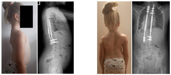 Less-Invasive Approach to Early-Onset Scoliosis—Surgical Technique for Magnetically Controlled ...